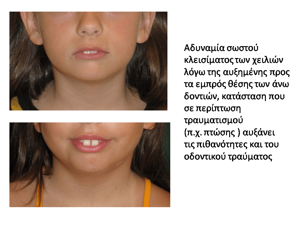 orthodontikoi-mixanismoi | Μαρία Χαραλαμπίδου Ορθοδοντικός