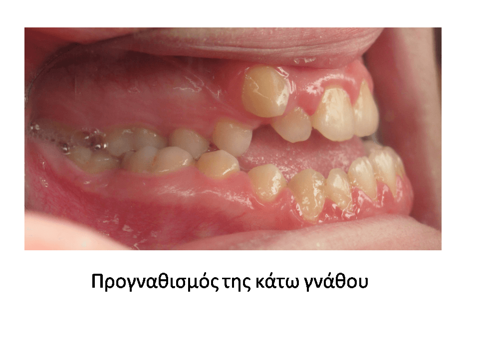 orthodontikoi-mixanismoi | Μαρία Χαραλαμπίδου Ορθοδοντικός