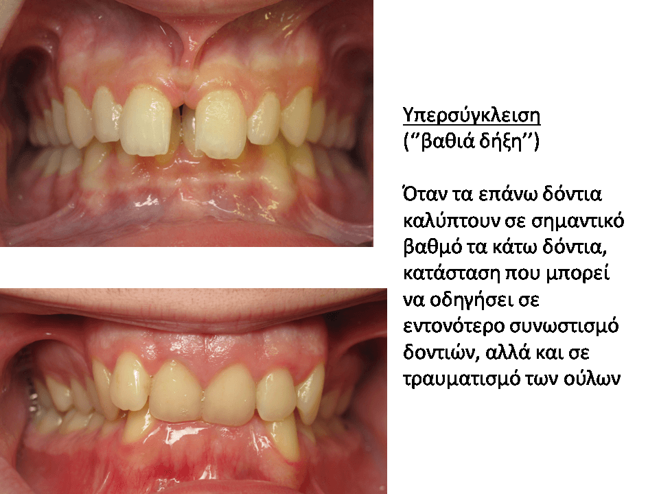orthodontikoi-mixanismoi | Μαρία Χαραλαμπίδου Ορθοδοντικός
