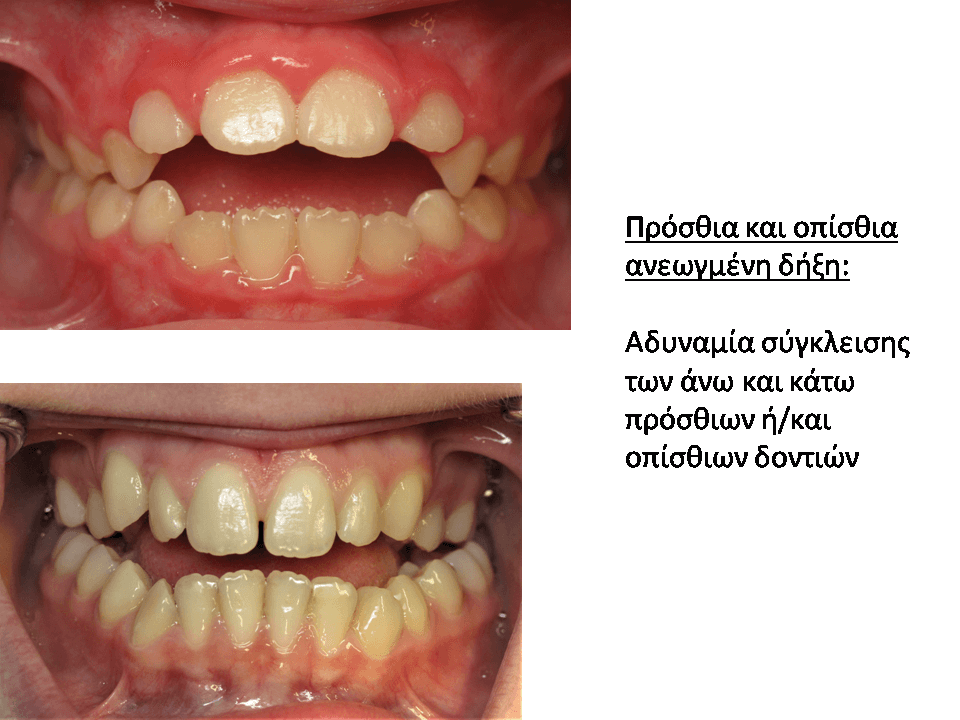orthodontikoi-mixanismoi | Μαρία Χαραλαμπίδου Ορθοδοντικός