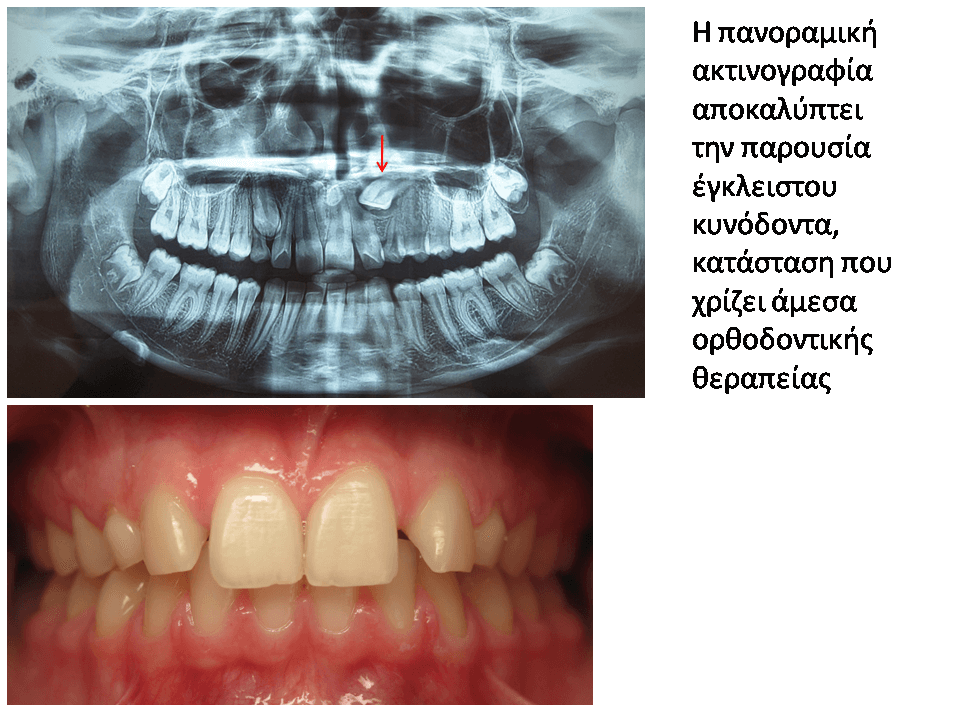 orthodontikoi-mixanismoi | Μαρία Χαραλαμπίδου Ορθοδοντικός